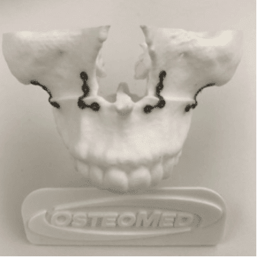 3D Orthognathic Model